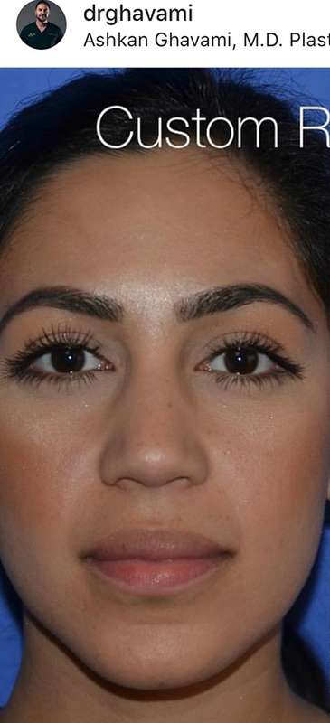 Patient #8332 Nose And Face Before and After Photos Beverly Hills, CA ...